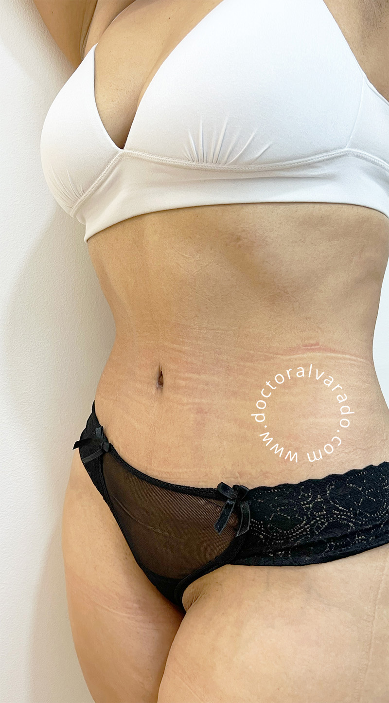 Tummy Tuck Colombia | Cirugía de Abdominoplastia Cali Tummy Tuck Colombia | Cirugía de Abdominoplastia Cali